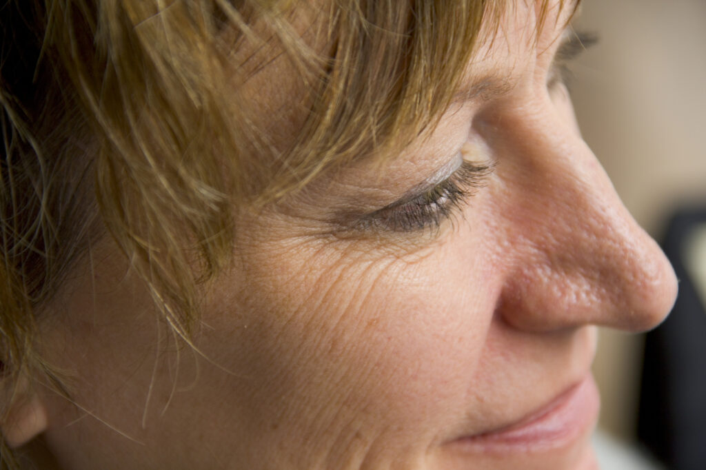 Botox Dynamic Wrinkle Training