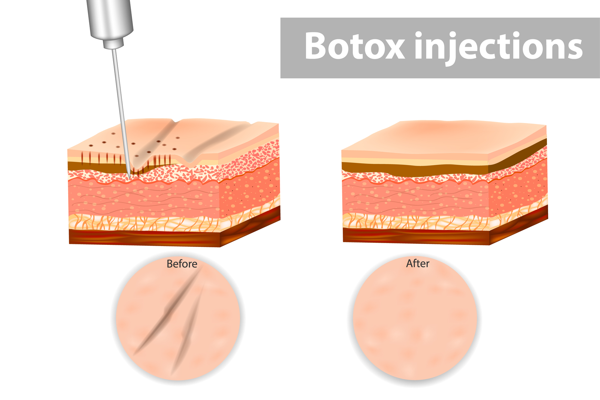 The Benefits of Botox: A Comprehensive Guide to the Procedures