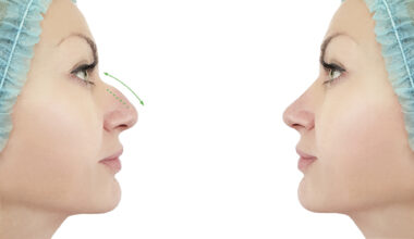 A Guide for Patients Receiving Nose-Tip Botox®