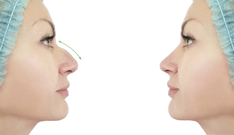 A Guide for Patients Receiving Nose-Tip Botox®