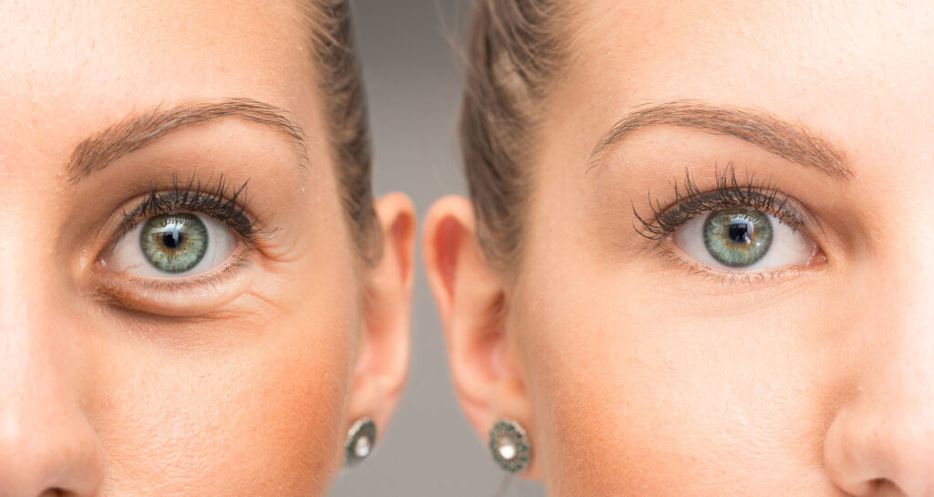 Under-Eye Botox: A Magical Way to Refresh Your Look